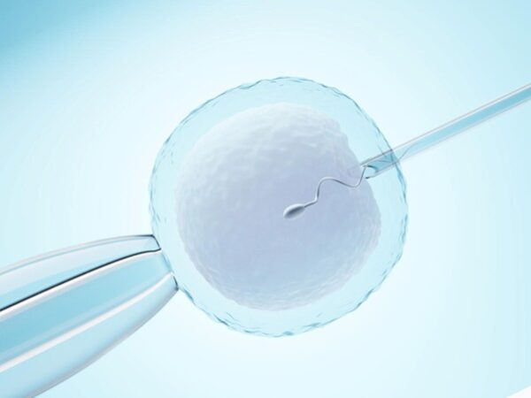 Understanding PICSI: Procedure, Benefits, and What to Expect